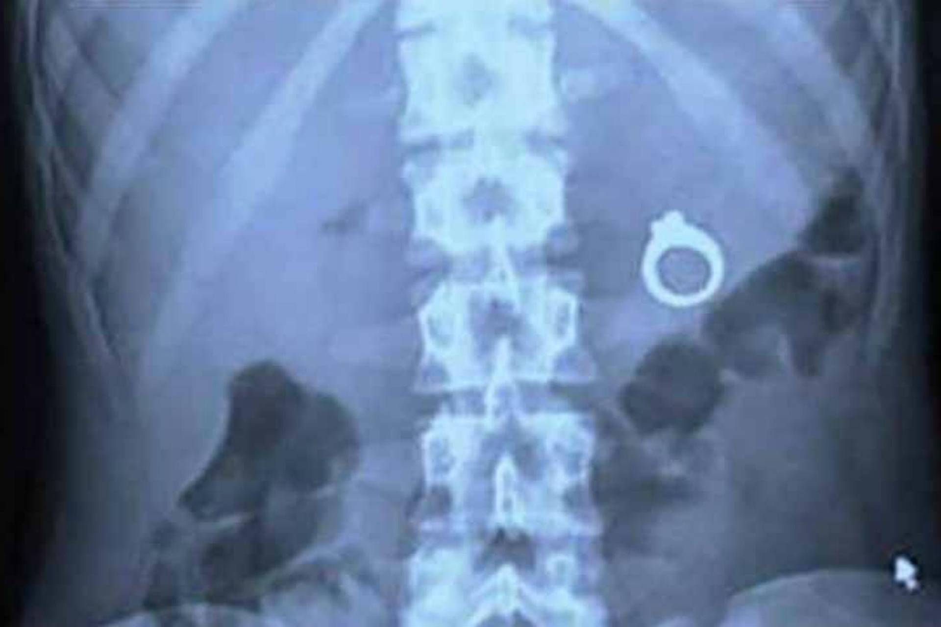 Altro che ingoiare il rospo! Ecco cosa rivelano le radiografie